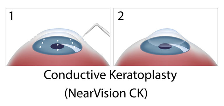 LASIK Las Vegas | Conductive Keratoplasty | Shepherd Eye